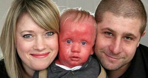 Syndrome de Netherton : les enfants à la peau rouge