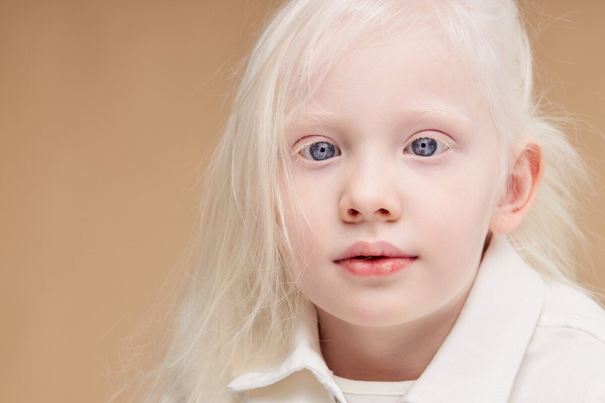 Comment prendre soin de la peau d'un enfant albinos?